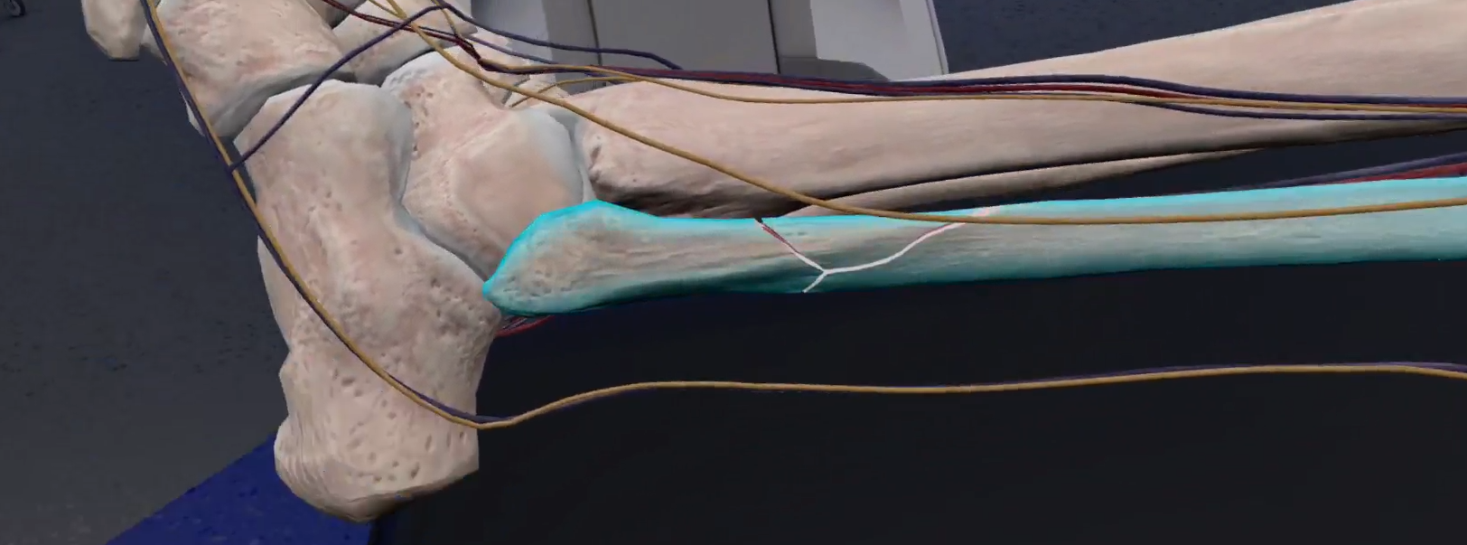 PrecisionOS Expands Into Podiatric Surgery - PrecisionOS
